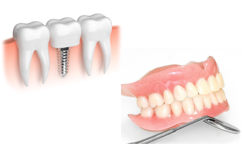 Dental Implants Vs Dentures A Comprehensive Analysis