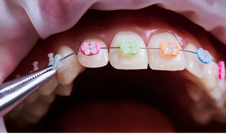 The Process of Removing Braces